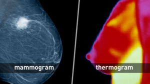 FDA: Breast Cancer Screening – Thermogram No Substitute for Mammogram ...